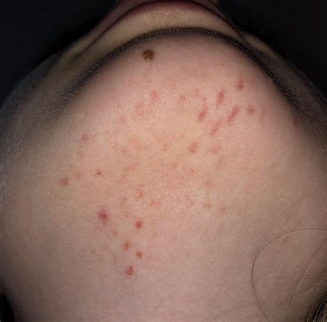 Small Purple Rash Bruises Caused By Sertralinezoloft Rssris