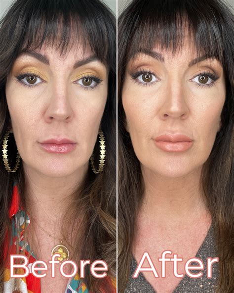 I Tried Cheek Filler For The First Time Let S Talk About It