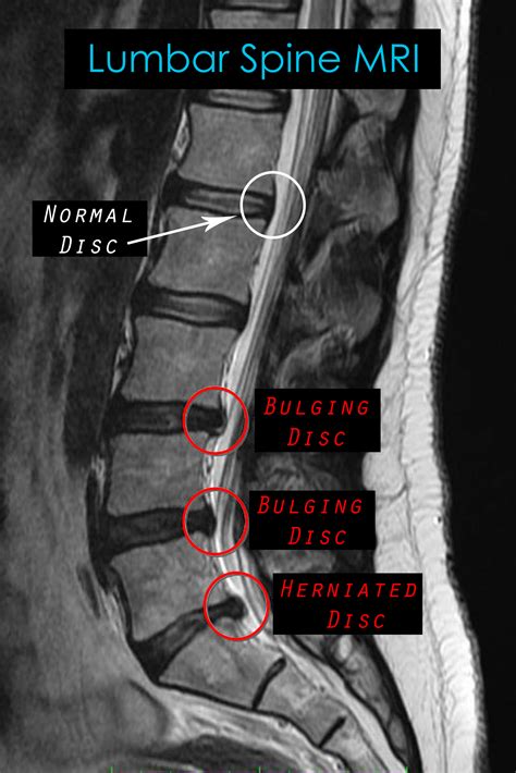 Sciatica Treatment Chiropractor Palm Coast New Spring Chiropractic
