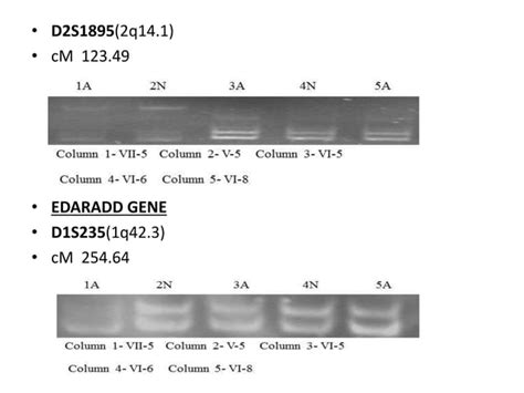 Ectodermal Dysplasias Genetic Disorder Pptx Skin And Dermatology