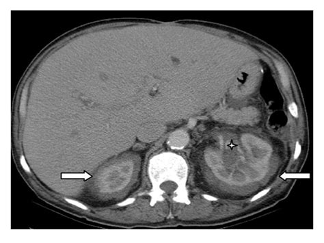 Diagnostic Imaging Of Perinephric Space