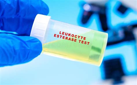 Detects The Enzyme Leukocyte Esterase Indicating The Stock Image