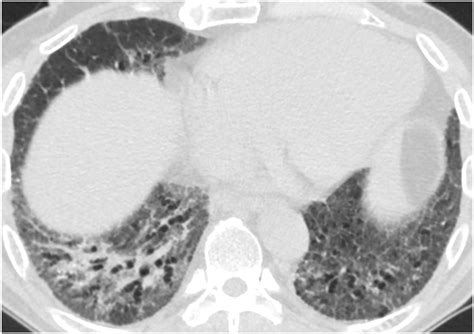 Subsolid Nodules Clinics In Chest Medicine