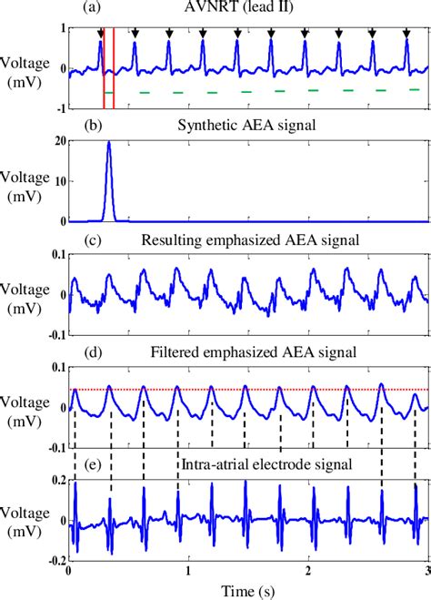 Figure From Supraventricular Tachycardia Classification In The Lead ECG Using Atrial Waves