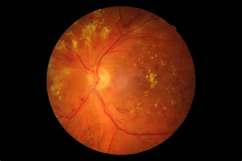Diabetic Retinopathy 2 Eyes Wide Bay