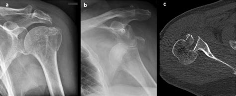 Tuberosities Fracture A Minimally Displaced Gt B Antero Posterior