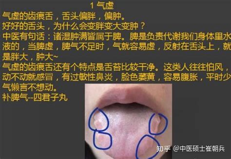 舌头边缘有齿痕印就一定是湿气重吗？错了，还有可能是这4种情况 知乎
