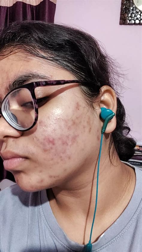 How Bad Are My Acne Scars And Is This Pie Or Pih How Do I Get Rid Of