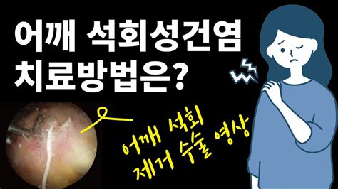어깨통증 석회성건염 증상과 치료 방법실제 수술영상 Youtube