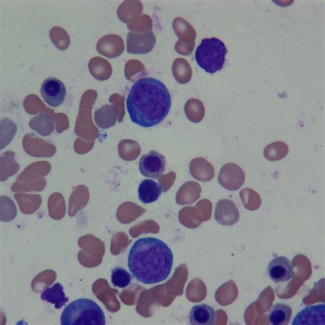 Flow Cytometry Results Of Bone Marrow Aspirate Obtained At Diagnosis