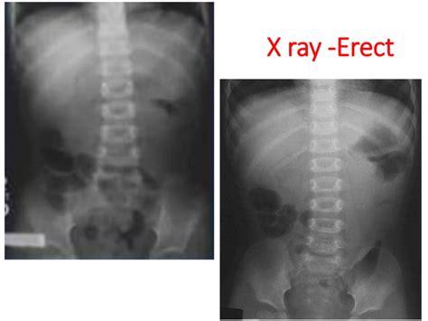 Pediatric Intussusception Pptx