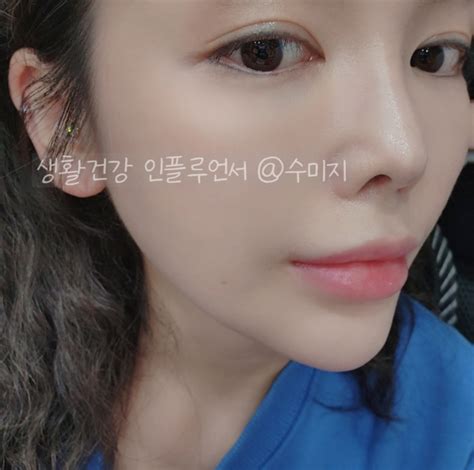 여드름약 이소티논 부작용 피지조절제 이소트레티노인 피부과 처방 네이버 블로그