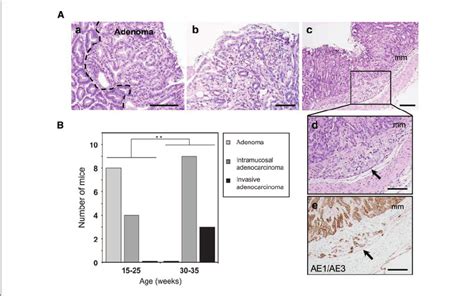 Gastric Tumors In Mnu Treated Apc Min Mice Show More Aggressive