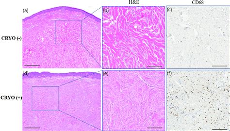 Histologic Analysis Of Keloids Treated With Cryotherapy Hematoxylin