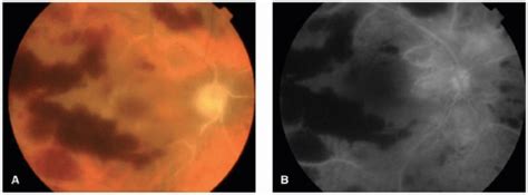 Infectious Posterior Uveitis Ento Key
