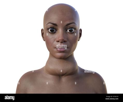 Computer Illustration Of A Woman With An Enlarged Thyroid And
