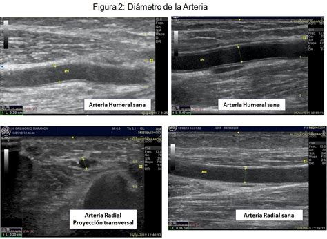 Ecografía Doppler en el Acceso Vascular Nefrología al día
