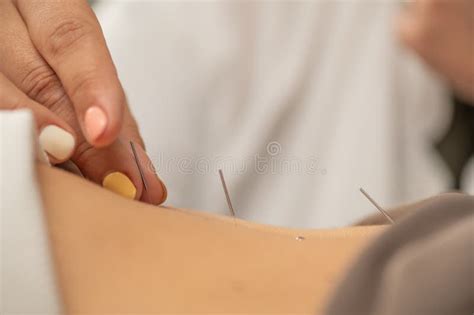 Acupuncture Session For Stress And Anxiety Stock Image Image Of Skin