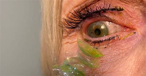 Alarming Video Shows Doctor Removing 23 Contact Lenses From Patient S Eye