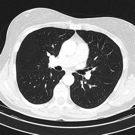 Diagnostics Of Lung Cancer Oncohema Key