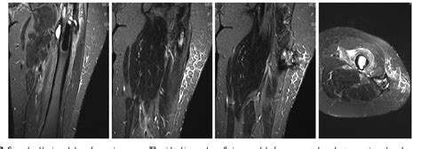 Figure 2 From Metagenomic Next Generation Sequencing Contribution In Identifying Prosthetic
