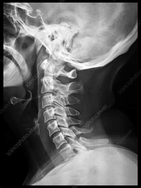 Normal Cervical Spine