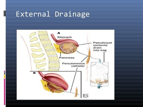 Pancreaticpseudocyst 121203061530 Phpapp02