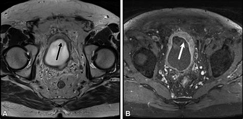 Urinary Bladder Masses Rare Subtypes And Masslike Lesions Radiologic Pathologic