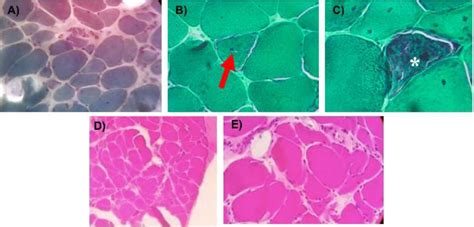 Inclusion Body Myositis A Late Diagnosis Case Report Reumatología