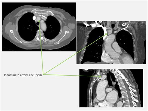 The Pump And The Tubes Innominate Artery Aneurysm