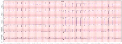 Examples Of Non Specifc ST Changes NST ECG Library