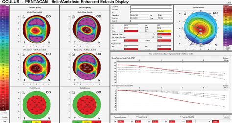 Corneal Tomography Increasingly Unreliable In Advanced Keratoconus