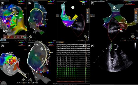The Ablation Catheter Can Be Entirely Seen From The Tip To The Shaft Download Scientific