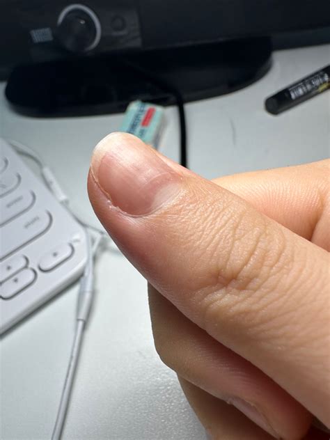 오른쪽 엄지 손톱 가운데에 곡선으로 선이 생기고 그 부분이 튀어나와있어요 ㅣ 궁금할 땐 아하