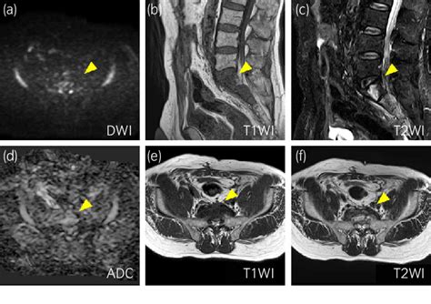 Mri Findings When The Re Elevation Of Hcg Levels Was Observed A Dwi