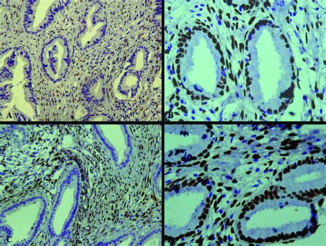 The Immunohistochemical Staining Of ER And PR ER And PR Were Found To