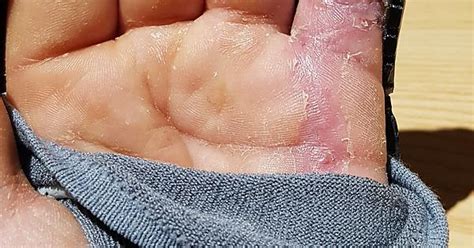 4 5 Weeks Post Fdp Tendon Repair Surgery Album On Imgur