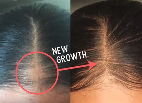 Success Bald Spot Growth Recipe Ms Full Hair