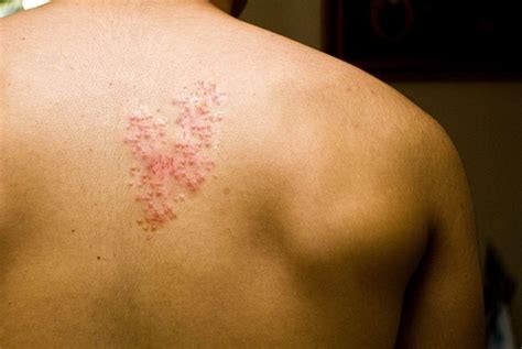 Shingles Symptoms And Treatment