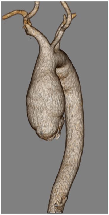 Three Dimensional Reconstruction Demonstrating Ascending Thoracic