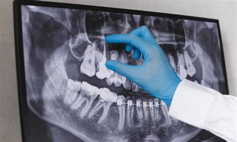 Root Canal X Ray Procedure Sobhan Teb Taer