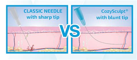 Dermal Filler Needle Vs Cannula