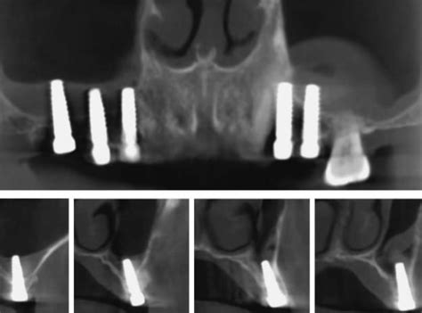 ELEVACION DE SENO MAXILARLa Tecnica Mediante Dispositivo Piezoelectrico
