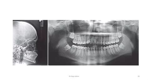 Infra Zygomatic Crest Implants Izc Pptx