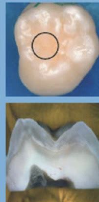Caries Detection And Resolution Flashcards Quizlet
