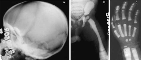 Radiological Phenotype Of Patient 8 With A Clcn7 Mutation A The Download Scientific Diagram