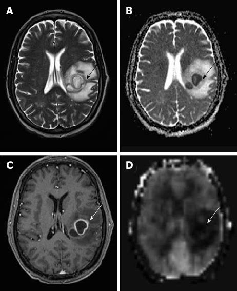A Case Of Abscess In The Left Frontoparietal Lobe T2wi A Shows Download Scientific Diagram