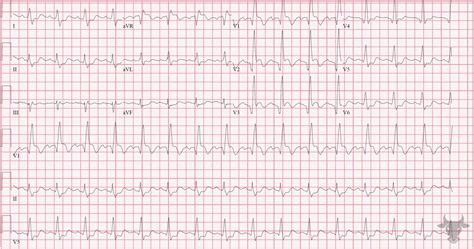 Right Bundle Branch Block ECG Stampede