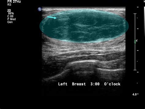 Atlas Of Breast Cancer Early Detection