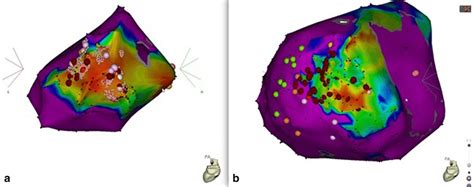 Endoepicardial Electroanatomic Map Of The Left Ventricle Showing A